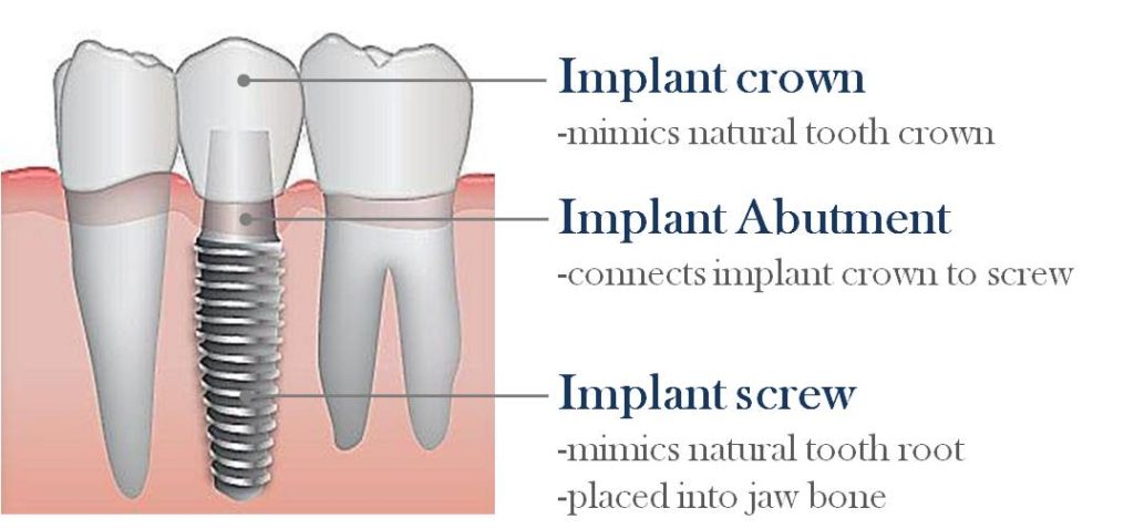 Dental Implants - Spring Periodontics